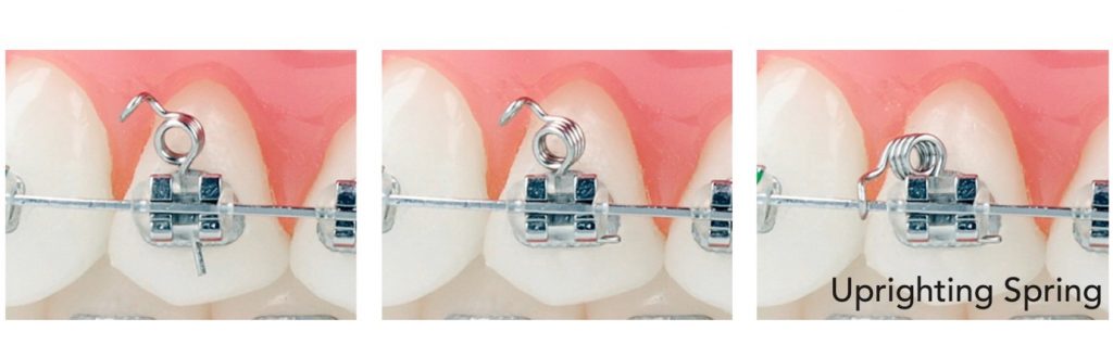 Lò xo dựng trục Uprighting Spring with safety hold – Vật Liệu Chỉnh Nha ...