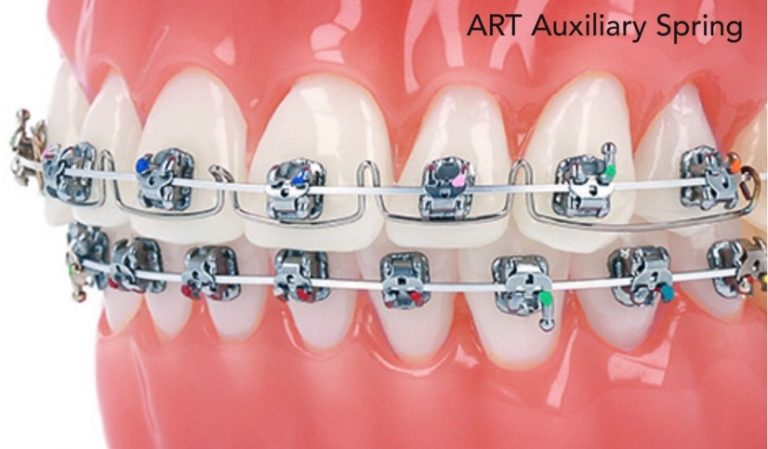 Lò xo Anterior Root Torquing (ART) – Vật Liệu Chỉnh Nha AO – American ...